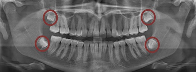 Tooth Extraction | Wisdom Tooth Removal | Garden City, KS