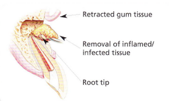 Endodontic Surgery | Apicoectomy | Dekalb, IL