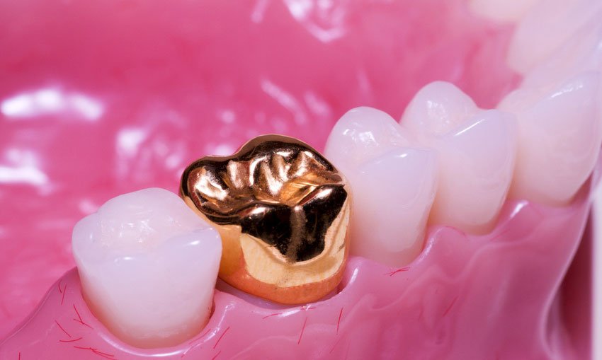 Gold Dental Crowns | PFM Bridges | Corydon, IN
