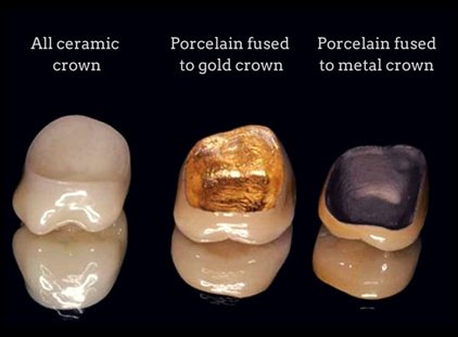 Dental Restoration | Porcelain Crowns | Pueblo, CO