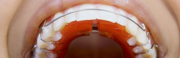 Retainer Repairs | Braces | Boulder, CO