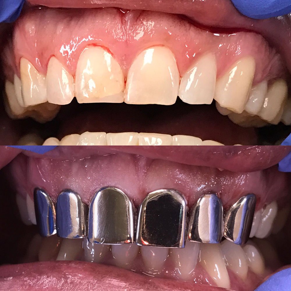 Gold Crowns | Gold Dental Work | Mobile, AL