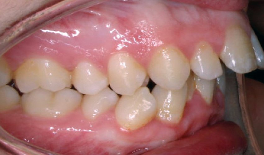 Brent P. Collins DDS, MS | Common Teeth Issues | Maryville, TN