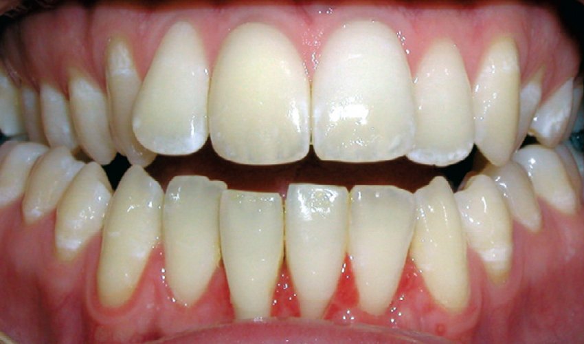 Brent P. Collins DDS, MS | Common Teeth Issues | Maryville, TN