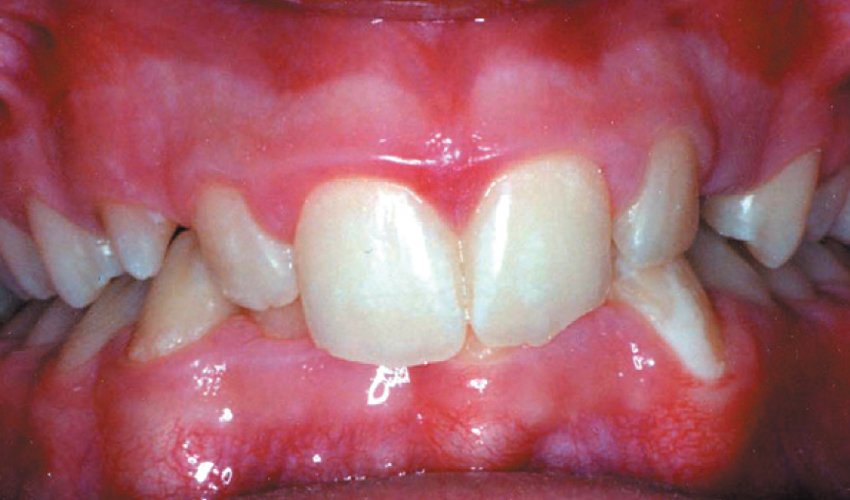 Brent P. Collins DDS, MS | Common Teeth Issues | Maryville, TN