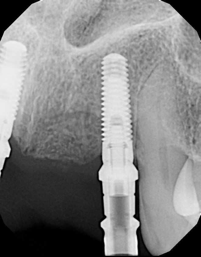 Dental Implants | Major and Minor Bone Grafting | Butler, PA