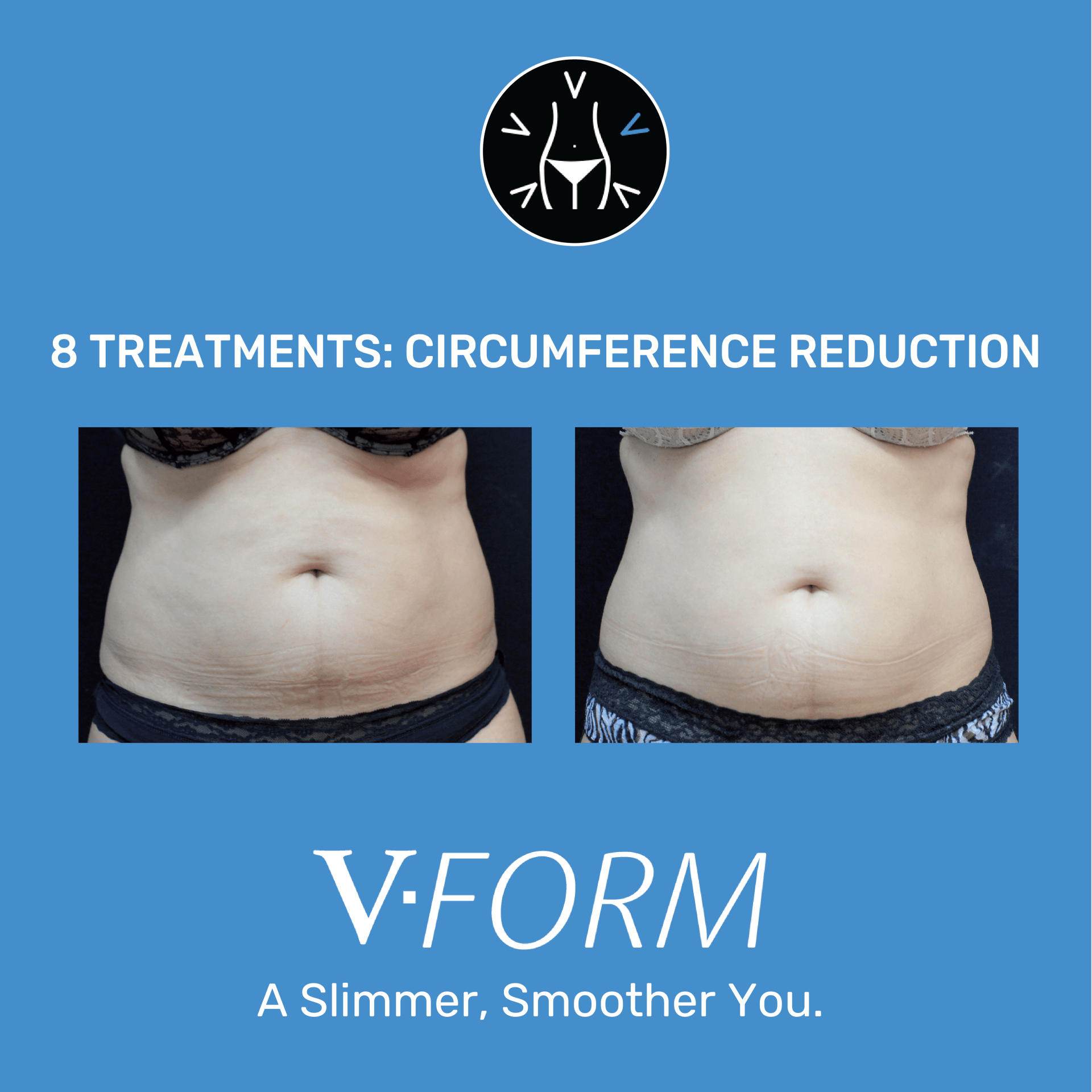 Body Contouring | Cellulite Reduction West Harrison NY