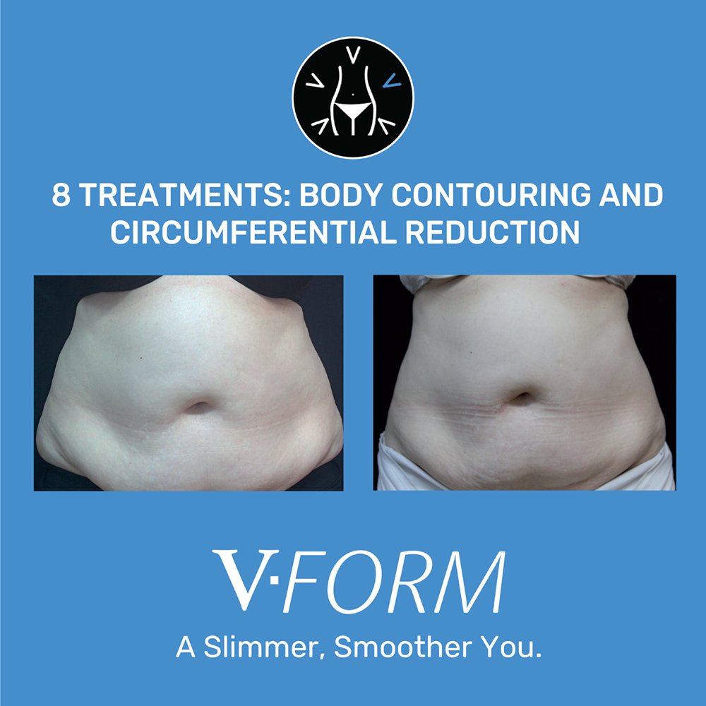 Body Contouring | Cellulite Reduction West Harrison NY