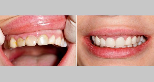Porcelain Crowns | Dental Crowns | Smryna, TN
