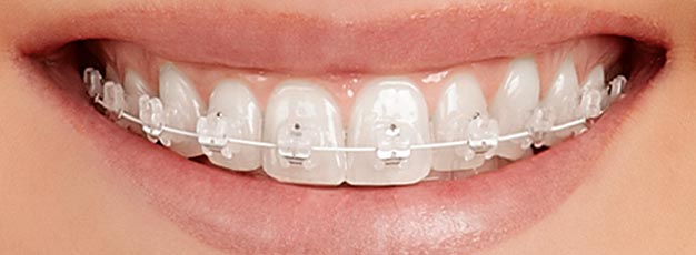 Self-Ligating Braces | Ceramic Braces | Ontario, OR