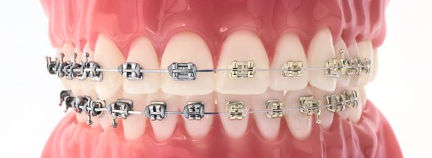 Self-Ligating Braces | Ceramic Braces | Ontario, OR
